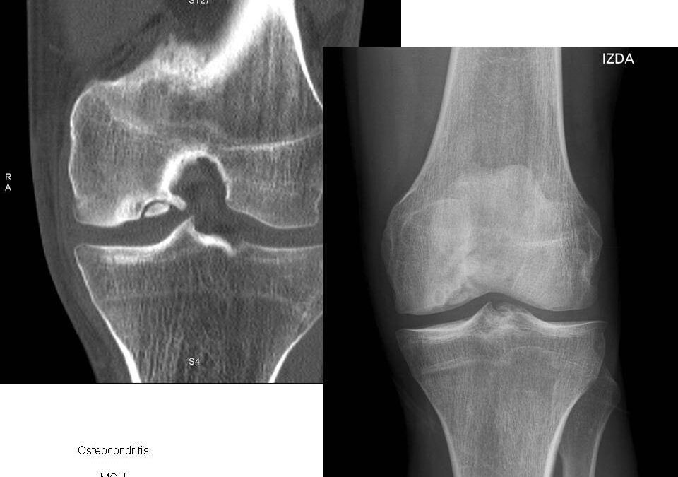 ¿Qué es la Osteocondritis? | Clínica Salud y Vida